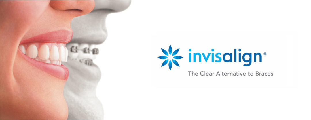 Invisalign® Cost: Save $1500 During Our Limited Time Promotion!